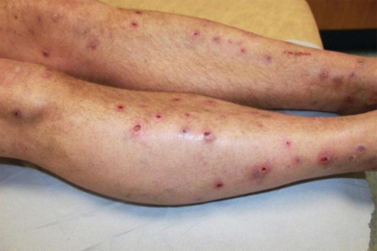 Psychogenic Pruritus: Causes, Symptoms, and Solutions | Ezbon Health
